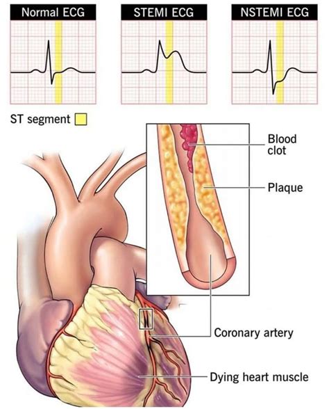 This Visual Offers A Clear Comparison Between A Normal Ecg Stemi And Nstemi— Zain Khalpey