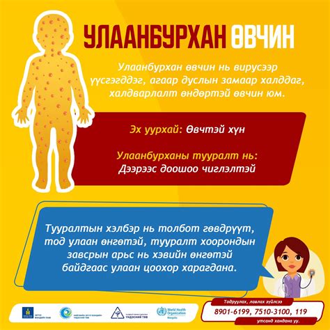 Нийгмийн эрүүл мэндийн үндэсний төв Улаанбурхан өвчин нь халдварлалт өндөртэй ч вакцинаар