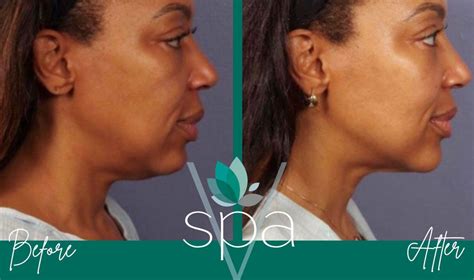 Morpheus 8 Skin Tightening And Resurfacing Spa V