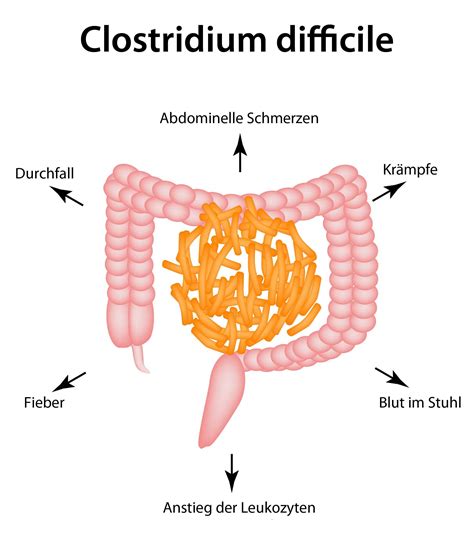 Clostridium Difficile Pseudomembranöse Enterokolitis