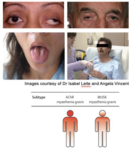 Myasthenia Gravis Flashcards Quizlet