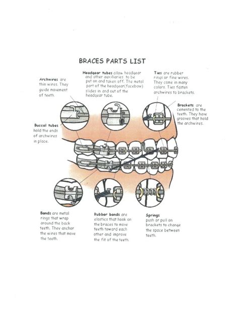 Braces Parts List Invisible Braces Braces List