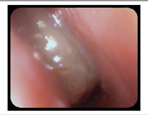 Sphenoid Sinus Polyp Semantic Scholar