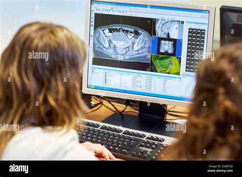 Imrt Intensity Modulated Radiation Therapy Rectal Cancer 3d