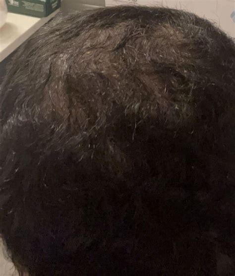 8 Months Post Ht R Hairtransplants