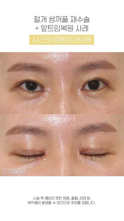 앞트임복원 쌍꺼풀재수술 동시에 가능합니다 Youtube