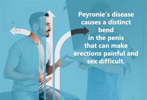 Peyronies Disease