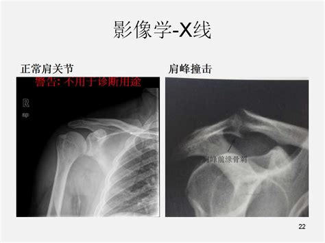 肩袖损伤的诊断与治疗技巧 好医术早读文章 好医术 赋能医生守护生命