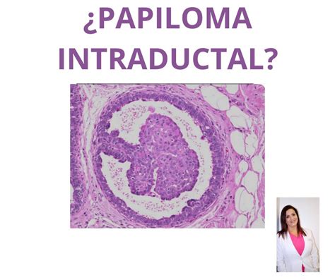 EL QUE TU BIOPSIA DE SENO DIGA QUE TIENES UN PAPILOMA INTRADUCTAL, NO QUIERE DECIR QUE TE TIENEN ...