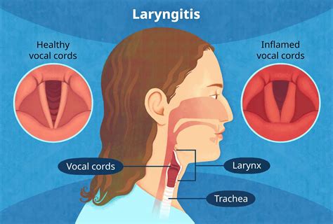 Laryngitis Causes What Is Laryngitis Know The Symptoms Causes And