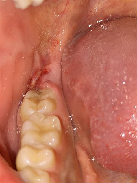 Is My Operculectomy Healing Correctly R Askdentists