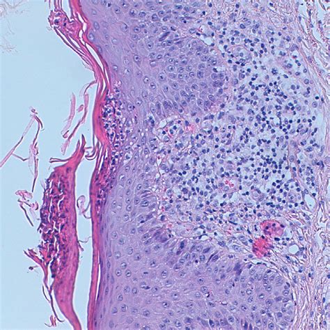 Confluent Erythematous Maculopapular Lesions Over The Chest And Abdomen