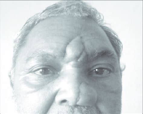 Clinical Photograph Of Patient One Month After Flap Division Post