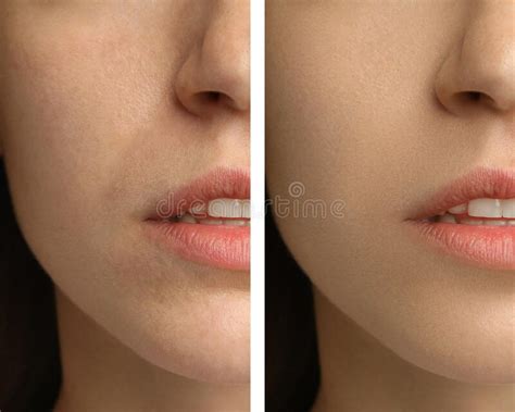 Collage With Photos Of Woman Having Dry Skin Problem Before And After