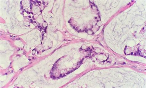 Microscopic Examination Reveals Within The Mucin Pools Are Clusters And