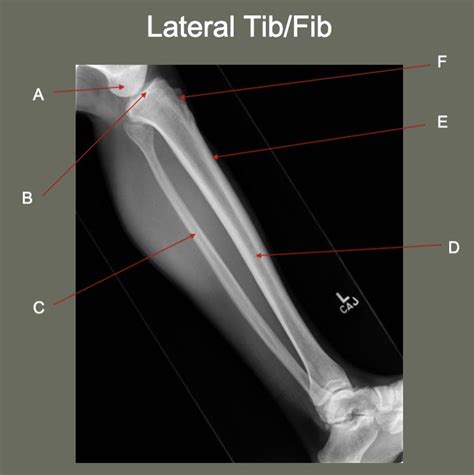 Tib Fib Lateral Diagram Quizlet Tib Fib Lateral Diagram Quizlet