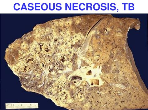 Ppt Cell Adaptations Cell Injury Cell Death Powerpoint Presentation