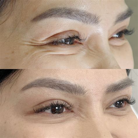 Anti Wrinkle Botulin Lift And Glow Prettylooks Aesthetic Center