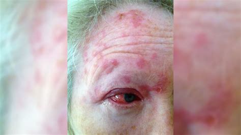 What Does Herpes Look Like Images