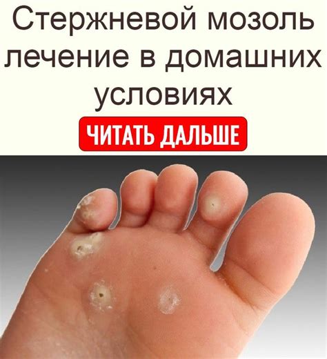 Стержневой мозоль лечение в домашних условиях в 2020 г Домашнее
