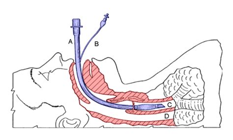 Ventilation And Intubation Rkmd