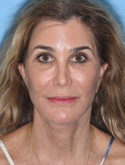 Endoscopic Brow Lift Female Case 3 Before And After Photos Delray