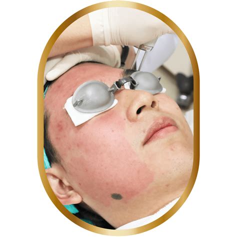 Pico Smooth Pico Bright Archives The Ritz Clinic เดอะริทซ์ คลินิก