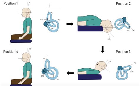 How To Treat Anterior Canal Bppv