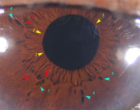 Modern And Multidimensional Iridology Pupil Flatness Collarette