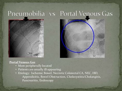 Pneumobilia 1