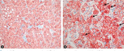 Figure 1 From β Catenin Activated Hepatocellular Adenoma Semantic Scholar