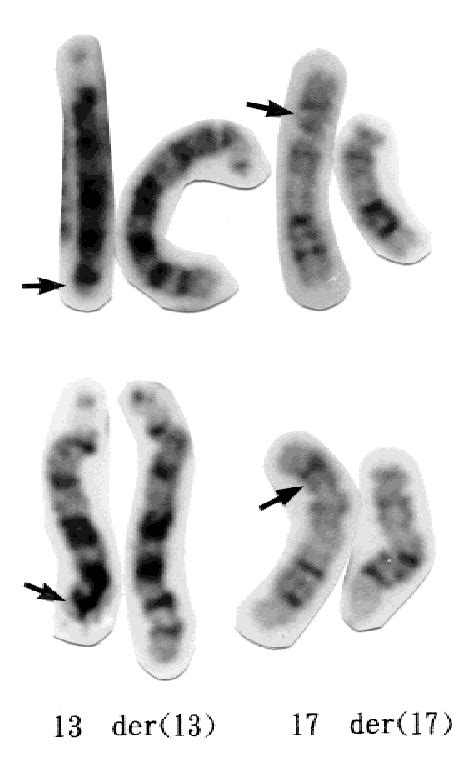 Pdf Congenital Scoliosis Hemivertebra Associated With De Novo
