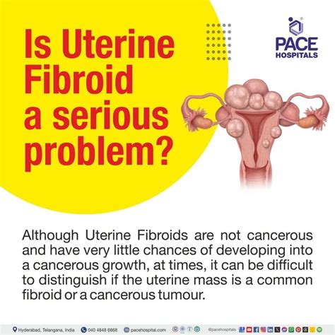 Pace Hospitals On Linkedin Fibroids Fibroiduterus Uterinefibroids