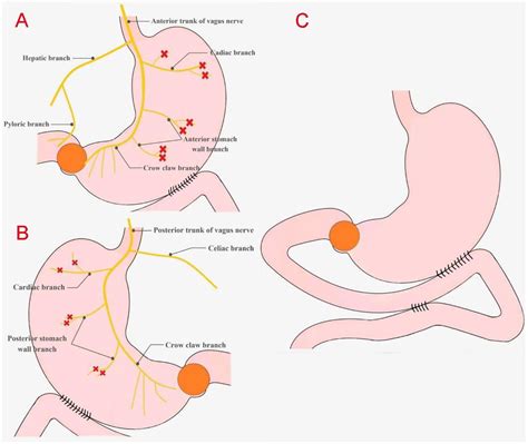 Exploring The Safety And Efficacy Of Stomach Partitioning