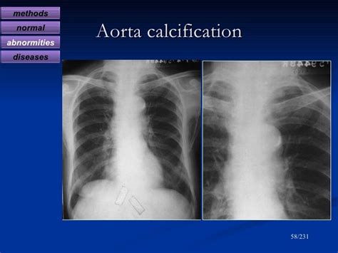Fresh 15 Of Calcified Aortic Knob Rapsodeperjuangan