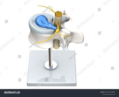 Illustration Showing Model Herniated Disc Lumbar Stock Illustration