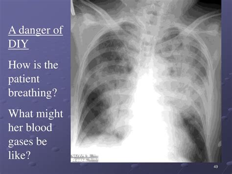Ppt Imaging The Normal And Abnormal Lung Powerpoint Presentation