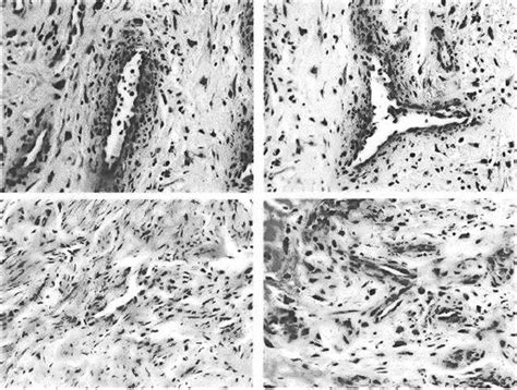 9 Oral Doxycycline Reduced Inflammation In Chronic Pressure Ulcer Top