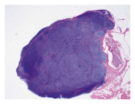A Lymph Node Specimen From This Case The Nodular Pattern Was Download Scientific Diagram