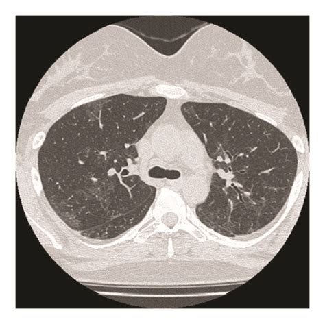 Chest Ct Scans Showing The Patients Middle A And Lower B Lung