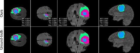 Figure 8 From Cross Modality Deep Feature Learning For Brain Tumor