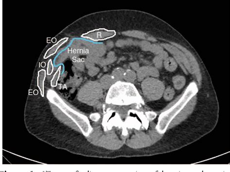 Figure 1 From Ventral Hernia After Hand Assisted Laparoscopic