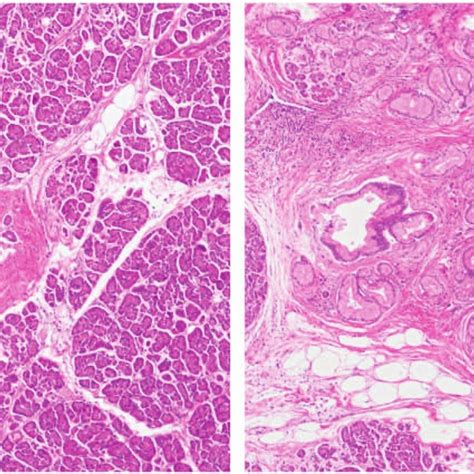 Pdf Diversity Of Precursor Lesions For Pancreatic Cancer The