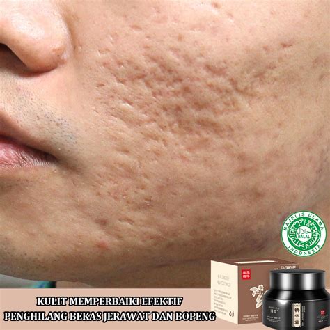 Jual Penghilang Bekas Jerawat Penghilang Bopeng Krim Cream Wajah 50g Obat Menghilangkan Bekas