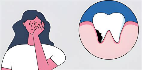 Cavities Dental Cariestooth Decay Stages Causes Treatment