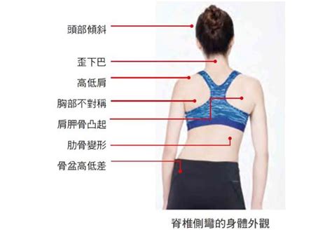 懷疑自己有脊椎側彎？除了x光，靠這2招肉眼也能檢測 蕃新聞