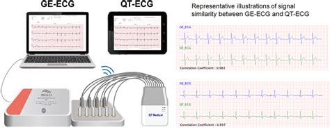 validation of 12 lead ecg signals between devices the proposed deep