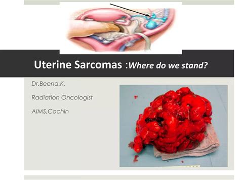 Uterine Sarcoma Ppt