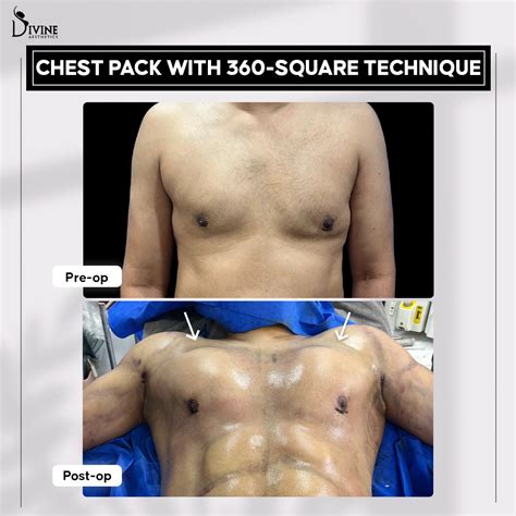Divine Divine Gynecomastia Male Plastic Surgery