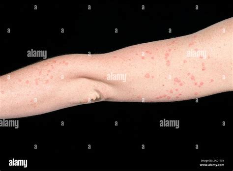 Polymorphic Eruption Of Pregnancy Arm Of A Pregnant Woman With